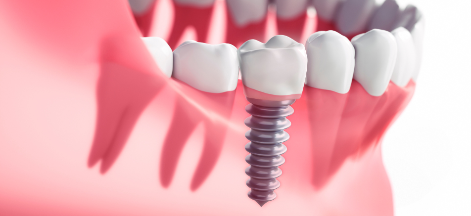 インプラント・自家歯牙移植 | 江東区亀戸の歯科、歯医者｜オーデンタルケアクリニック