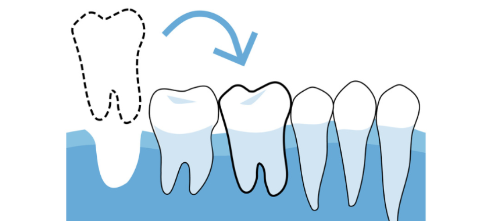 インプラント・自家歯牙移植 | 江東区亀戸の歯科、歯医者｜オーデンタルケアクリニック